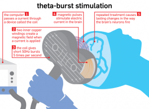 What is TBS (Theta-burst Stimulation) | TMS Center of Ventura